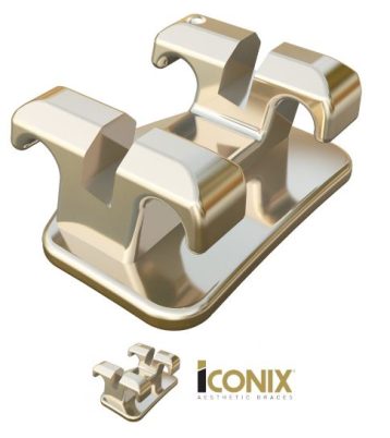 Iconix® Aesthetic Braces – Orthodontist Toronto | Invisalign Provider | Orthodontic Studio