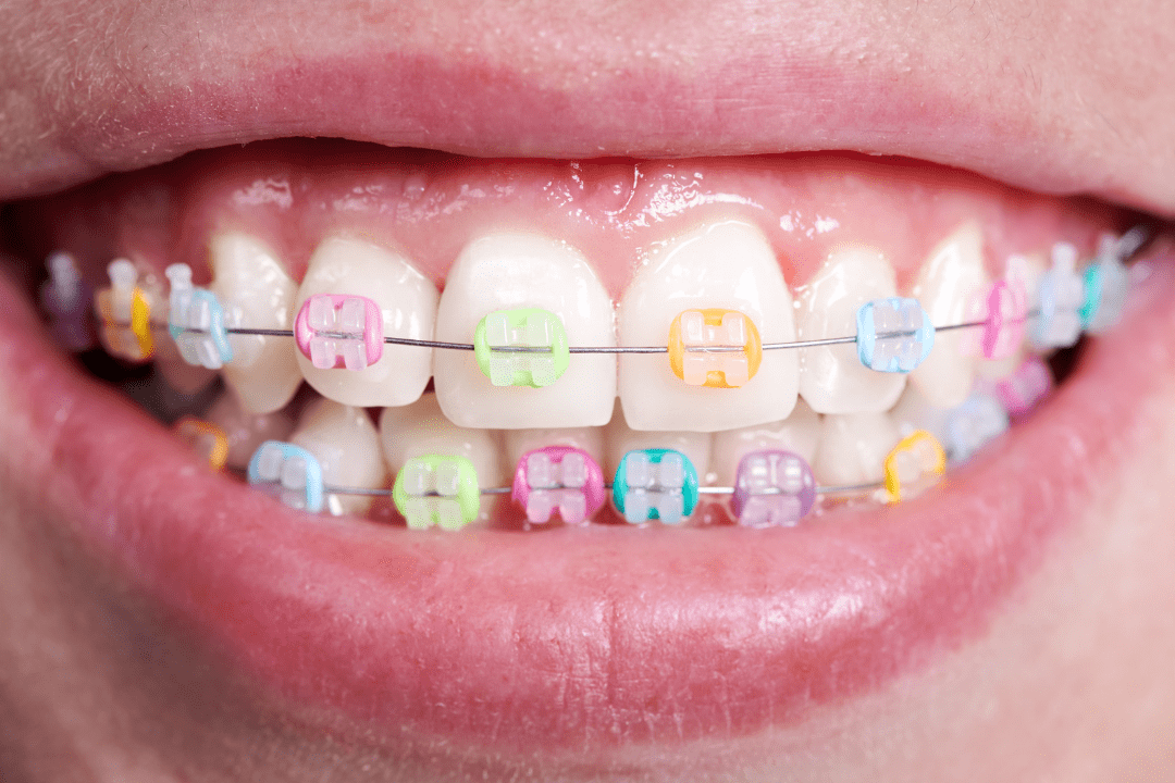 The Ultimate Guide to Orthodontic Treatment for Adults – Orthodontist Toronto | Invisalign ...