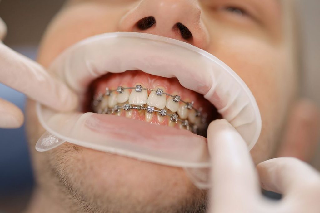 Orthodontic Banding VS Bonding: Which Treatment Is Right for You? – Orthodontist Toronto ...