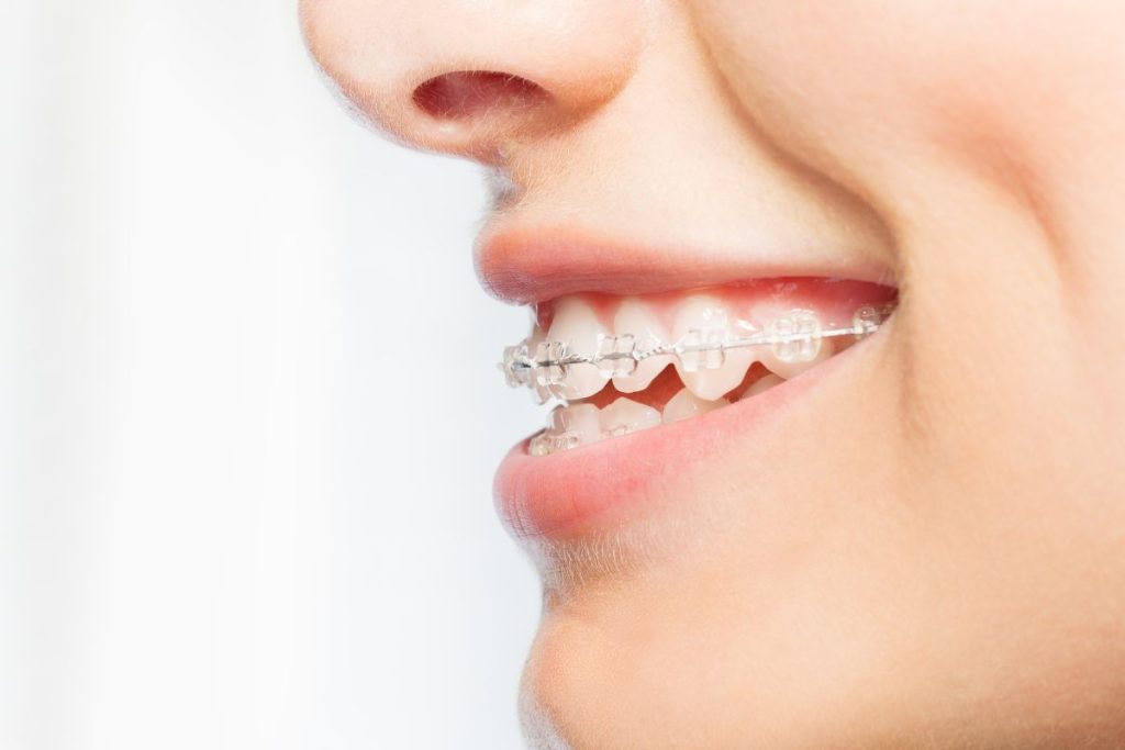 Difference Between an Overjet and Overbite: A Comprehensive Guide ...