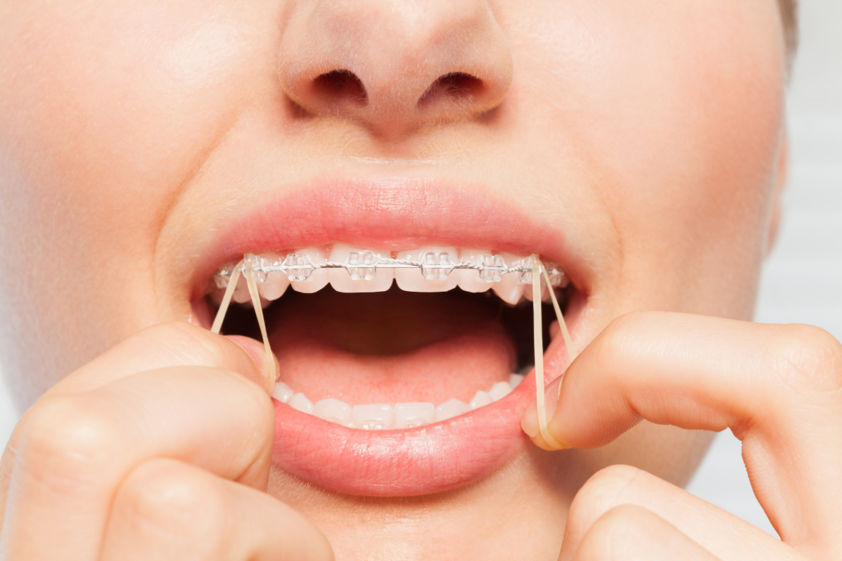 What are Brace Elastics? – Orthodontist Toronto | Invisalign Provider ...